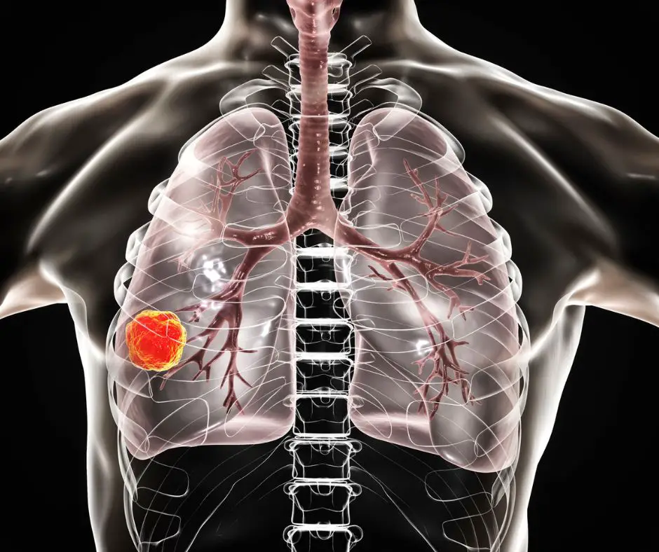 ¿Cuáles son los tipos de cáncer de pulmón?